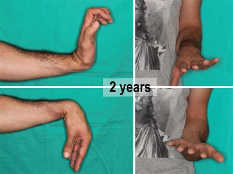 Free Osteochondral Fragment Musculoskeletal Key