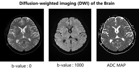 Diffusion Weighted Mri Dwi Mri Sequence Physics And Image Appearance