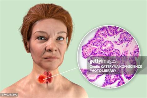Thyroid Gland Histology Photos And Premium High Res Pictures Getty Images