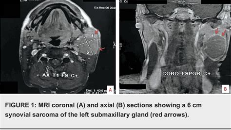 Figure 1 From Synovial Sarcoma Of The Submaxillary Salivary Gland A