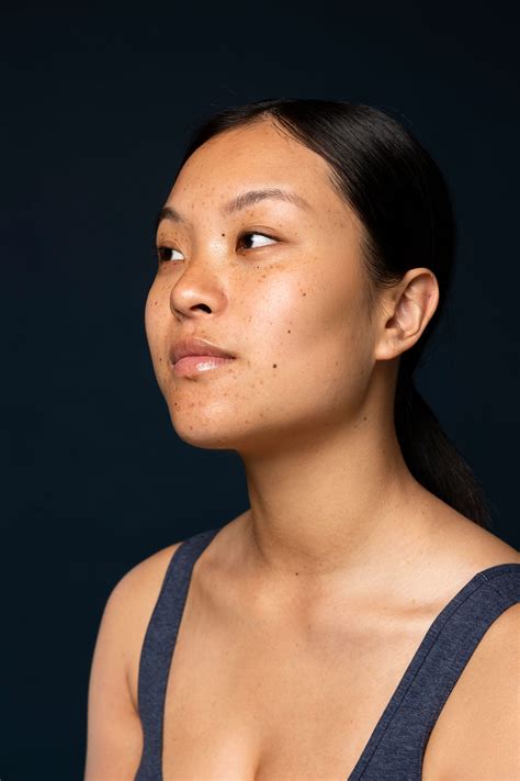 Chronicles Of The Skin Post Inflammatory Erythema And Post