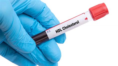 Cholestérol HDL définition analyse interprétation des résultats