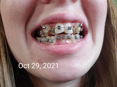 I Just Got My Braces On Today And I Feel Ugly I Was Never Insecure About My Appearance Before