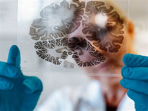 Brain Atrophy Symptoms Causes And Outlook