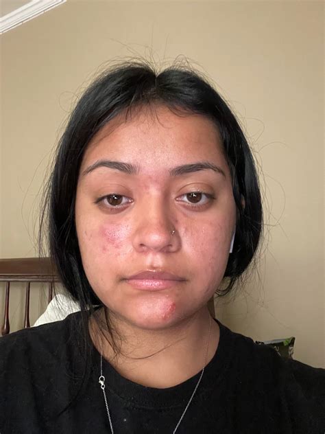 Done W Accutane Progress Pics And Skin Recently Raccutane