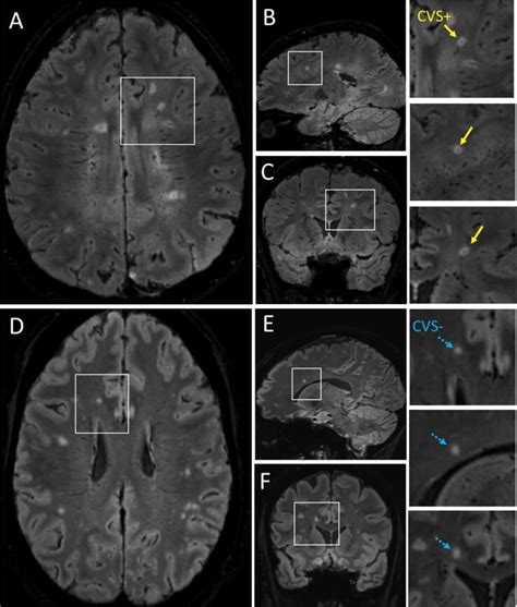 Central Vein Sign A Diagnostic Biomarker In Multiple Sclerosis Cavs