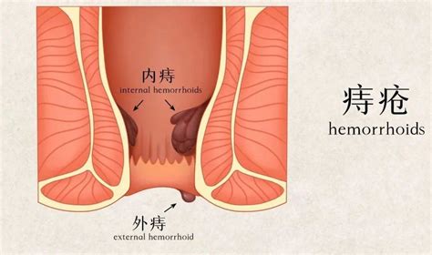 痔疮的早期和晚期症状有哪些？肛肠治疗大便