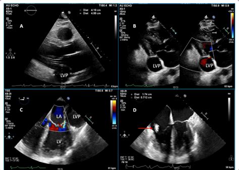 A And B Preoperative Tte Demonstrating Left Ventricular Pseudoaneurysm