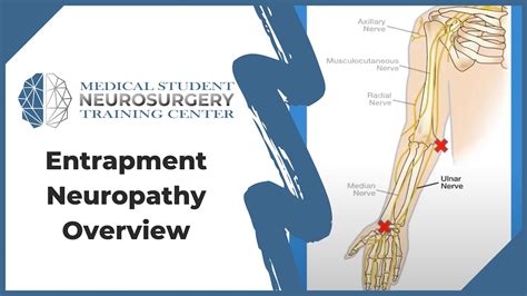 Entrapment Neuropathy Overview Youtube