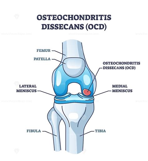 Osteochondritis Dissecans Or Ocd Bone And Cartilage Condition Outline