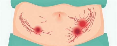 Scarring After Appendectomy Healing Care And Prevention Tips