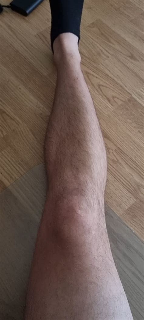 Weird Knee Locking Issue Video Rkneesovertoes