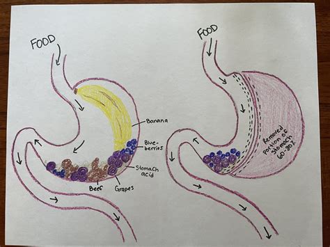 Laparoscopic Vertical Sleeve Gastrectomy Human Steam