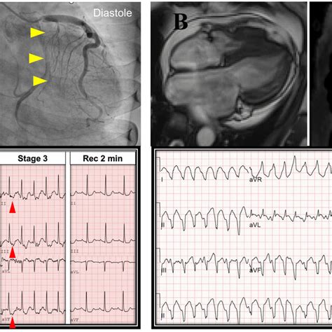 Representative Case For Hypertrophic Cardiomyopathy A Case Of