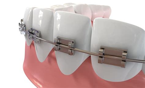Parts Of Braces The Wire Portland Braces