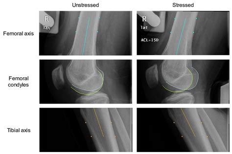 Computer Assisted System In Stress Radiography For Anterior Cruciate