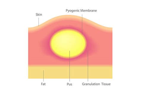 Clear Liquid Pimple Reason Of Formation And How To Treat It
