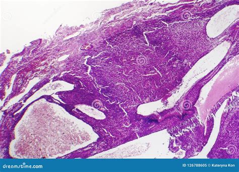 Fibrosarcoma Malignant Tumor Of Fibroblasts Stock Image Image Of