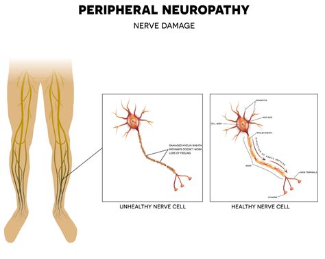 Small Fiber Neuropathy Causes And Treatment Artofit