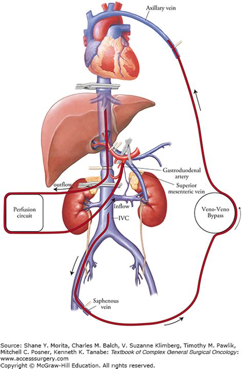 Regional Cancer Therapy Isolation Perfusion Isolation Infusion And Regional Cancer Therapy Isolation Perfusion Isolation Infusion And