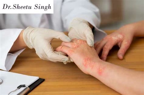 Fungal Infection What Are Fungi Risks Types Symptoms Causes