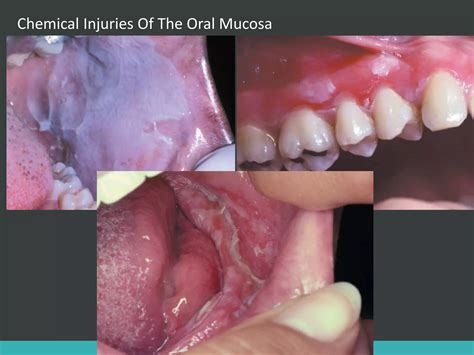 White Lesions Of Oral Cavity Pptx White Lesions Of Oral Cavity Pptx