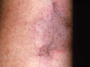 Calciphylaxis Prevention And Treatment Strategies Renal And Urology News