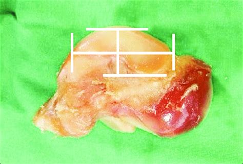 Actual Measurement Of Trochlear Medial Facet Height Longitudinal