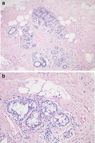 Histology From The Breast Of A 55 Year Old Transgender Woman Treated