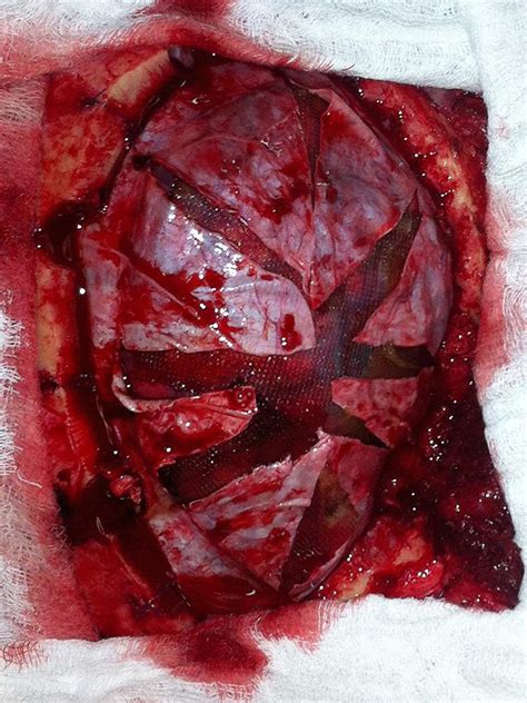 Brain Craniotomy Rdamnthatsinteresting