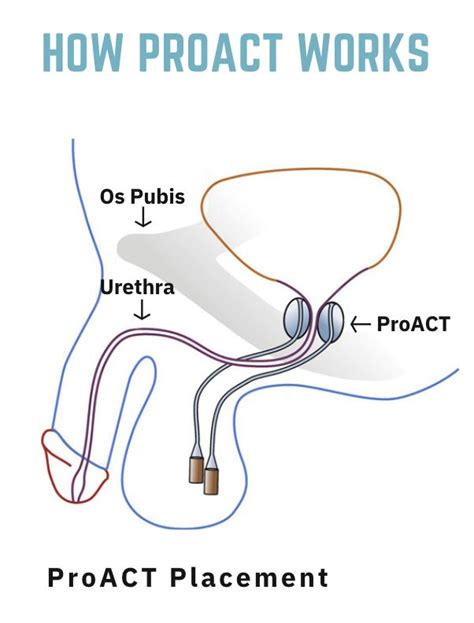 Sui Proact Urology Uromedica Inc