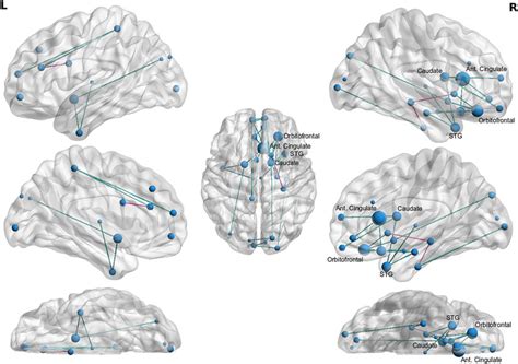 Network Based Statistic Identified Dti Structural Connectivity Network