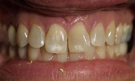 Dentist Woodland Hills Ca Veneers For Misaligned Teeth
