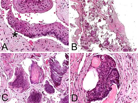 The Epithelial Whorl Or Morule Like Structure Asterisk Observed In