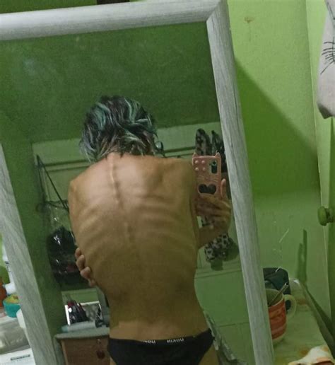 Anorexic Girl Crying