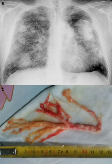 Plastic Bronchitis In A Patient With Silicosis Archivos De Bronconeumología