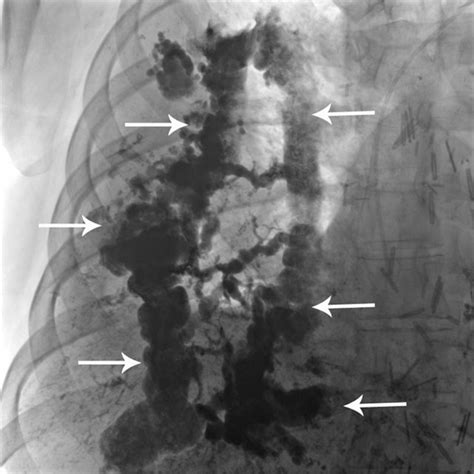 A Design Of The Vascularized Submental Lymph Node Flap With A 9 Â 25