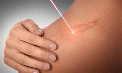 How To Naturally Dissolve Internal Scar Tissue Apollo Soft Tissue And