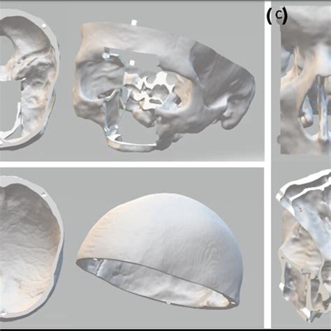Computational Model Of The Skull Segmented From The Cbct Image The