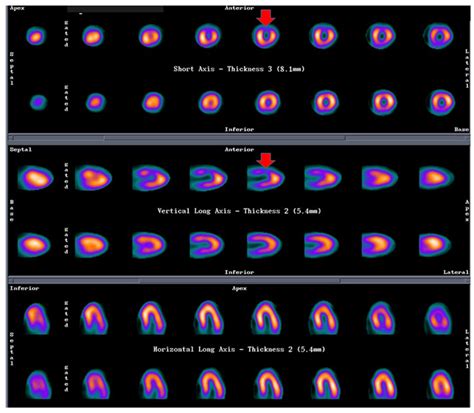 Life Free Full Text Cardiac Imaging In Women With Ischemic Heart
