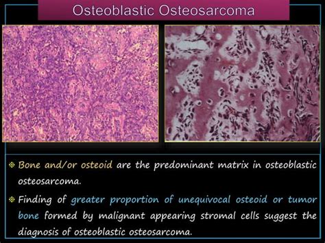 Osteosarcoma Ppt Bone And Joint Conditions Diseases And Conditions
