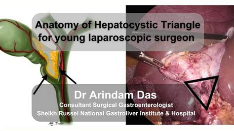 How Do An Amateur Laparoscopic Surgeon Identify Hepatocystic Triangle