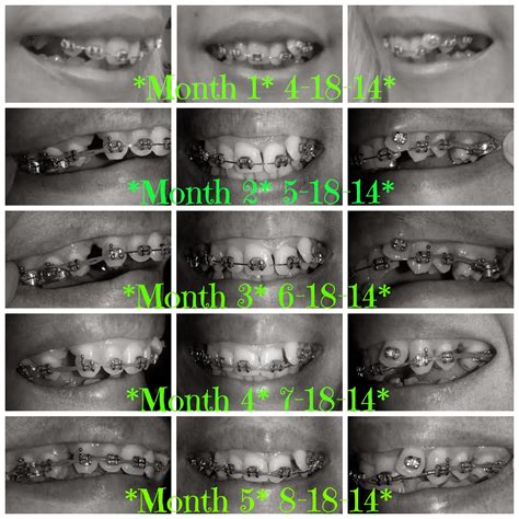 Adult Braces My Journey 5th Month Update With Braces