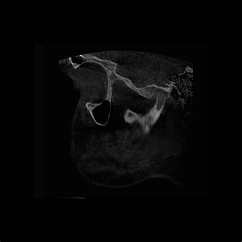 Ct Scan Of The Tmj Roboflow Universe