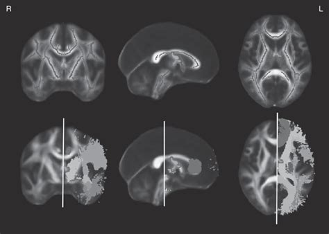 Map Of The Mean Diffusivity Md Differences Between Groups Patients Download Scientific