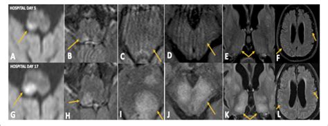 Case 1 Initial Mri Brain On Hospital Day 5 Demonstrated Diffusion
