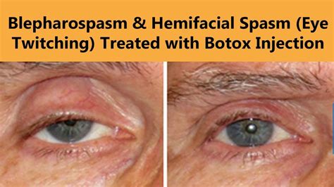 Blepharospasm Botox Before And After