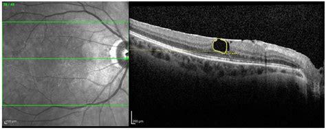 Macular Microvascular Modifications In Progressive Lamellar Macular Holes