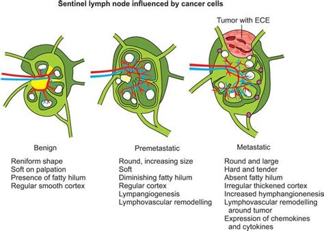 Lung Cancer Metastasis To Cervical Lymph Nodes