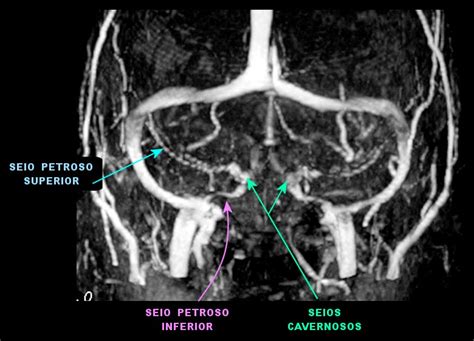 Seno Petroso Superior